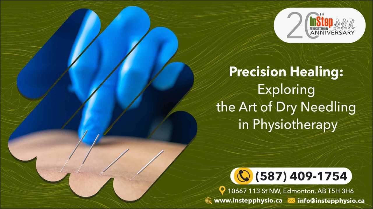 Precision Healing: Exploring the Art of Dry Needling in Physiotherapy ...