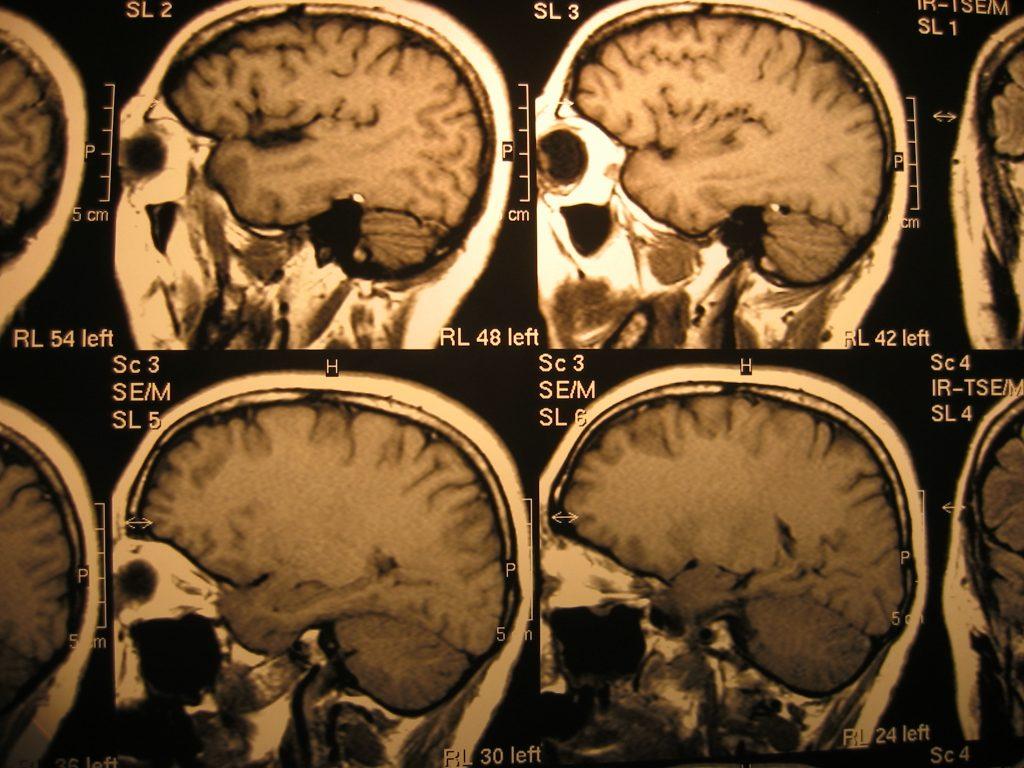 The Causes and Consequences of a Brain Stem Injury - INSCMagazine