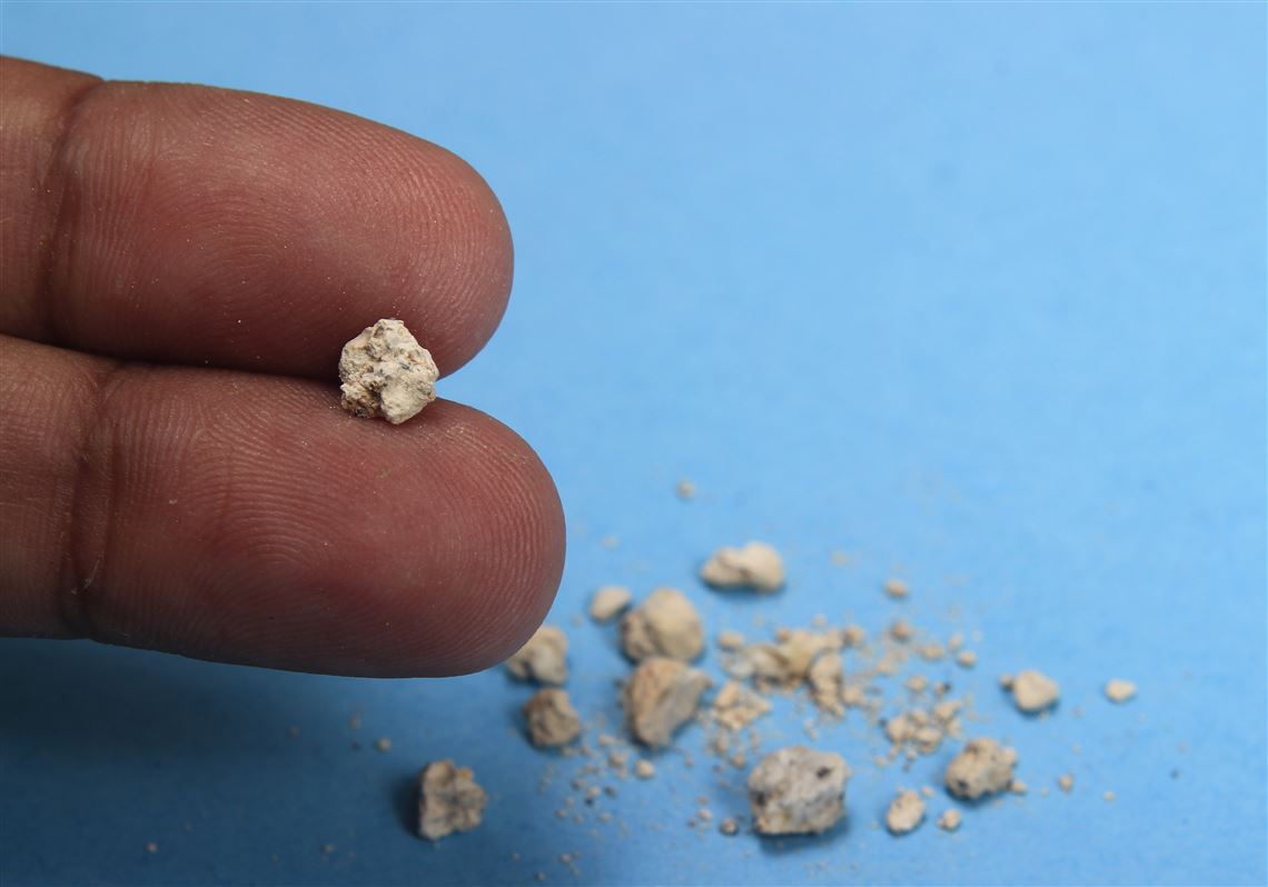 Understanding the Causes and Prevention of Kidney Stones - INSCMagazine